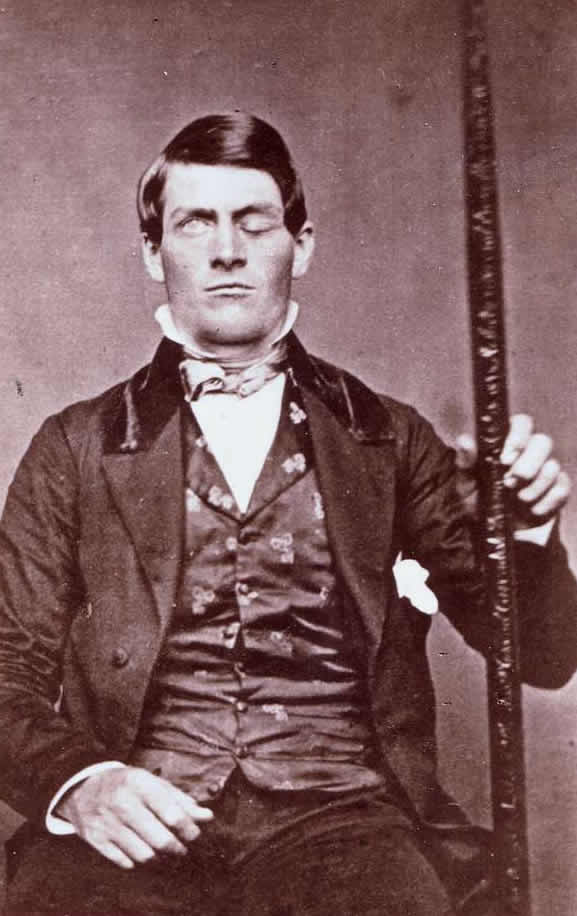 Phineas Gage: The Man Who Survived an Iron Rod Through His Brain ...